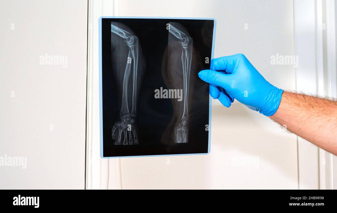 X-ray injury to the right forearm, A male doctor examines the injury to ...