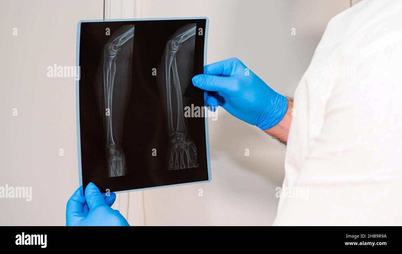 X-ray injury to the right forearm, A male doctor examines the injury to ...