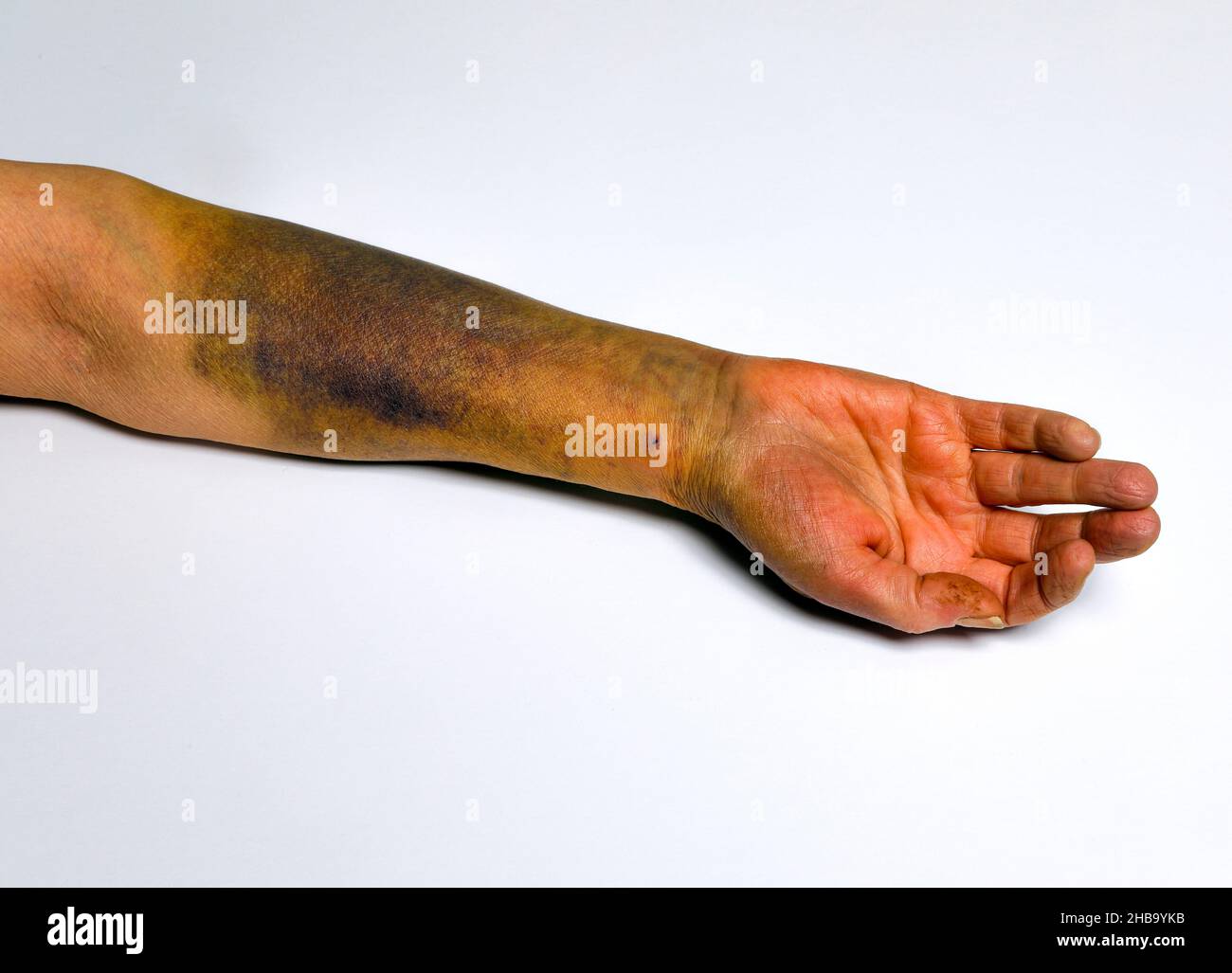 Detail bruised arm hi-res stock photography and images - Alamy