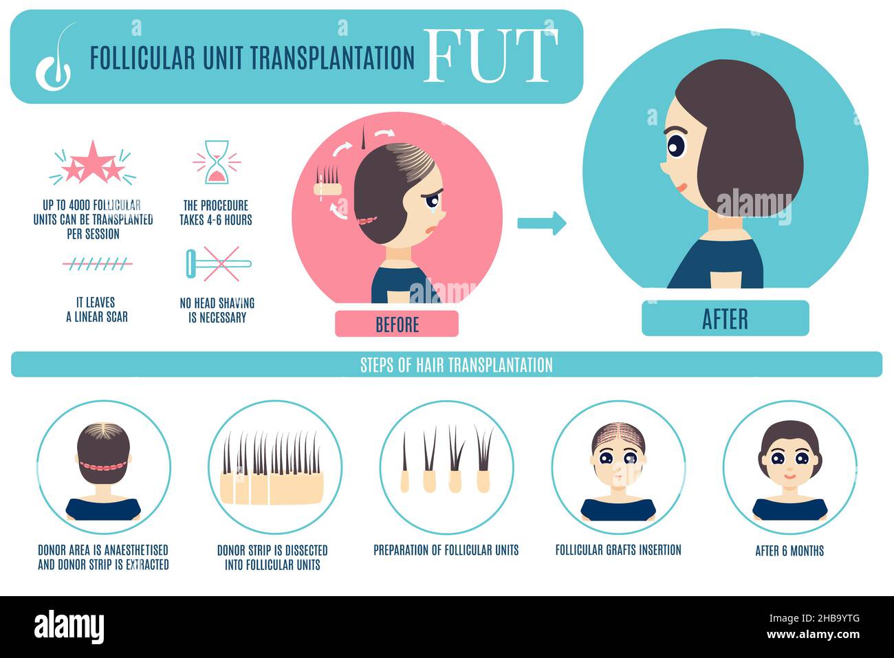 Follicular Unit Transplantation Fut Hair Transplantation In Women