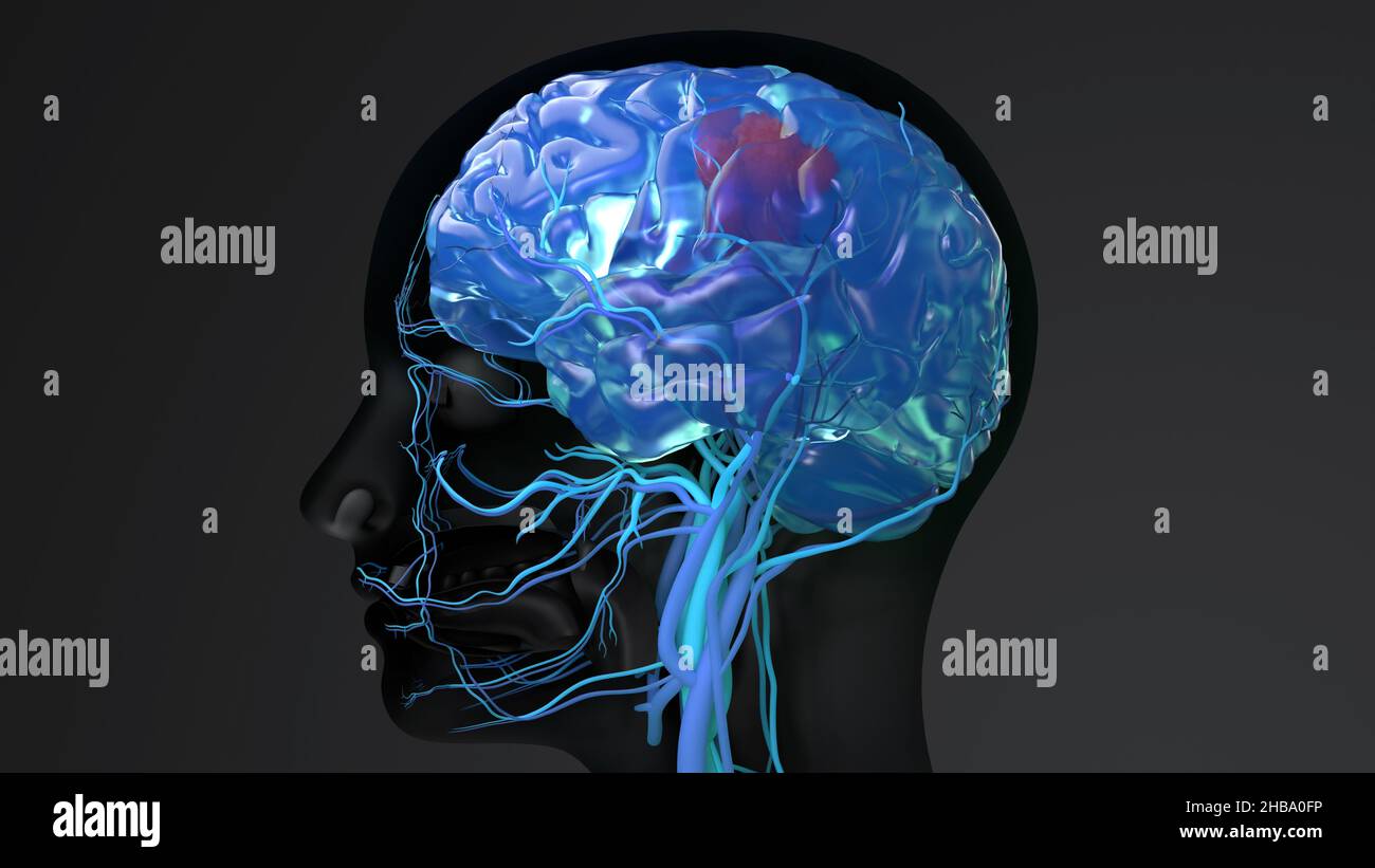 Brain cancer, conceptual illustration Stock Photo - Alamy