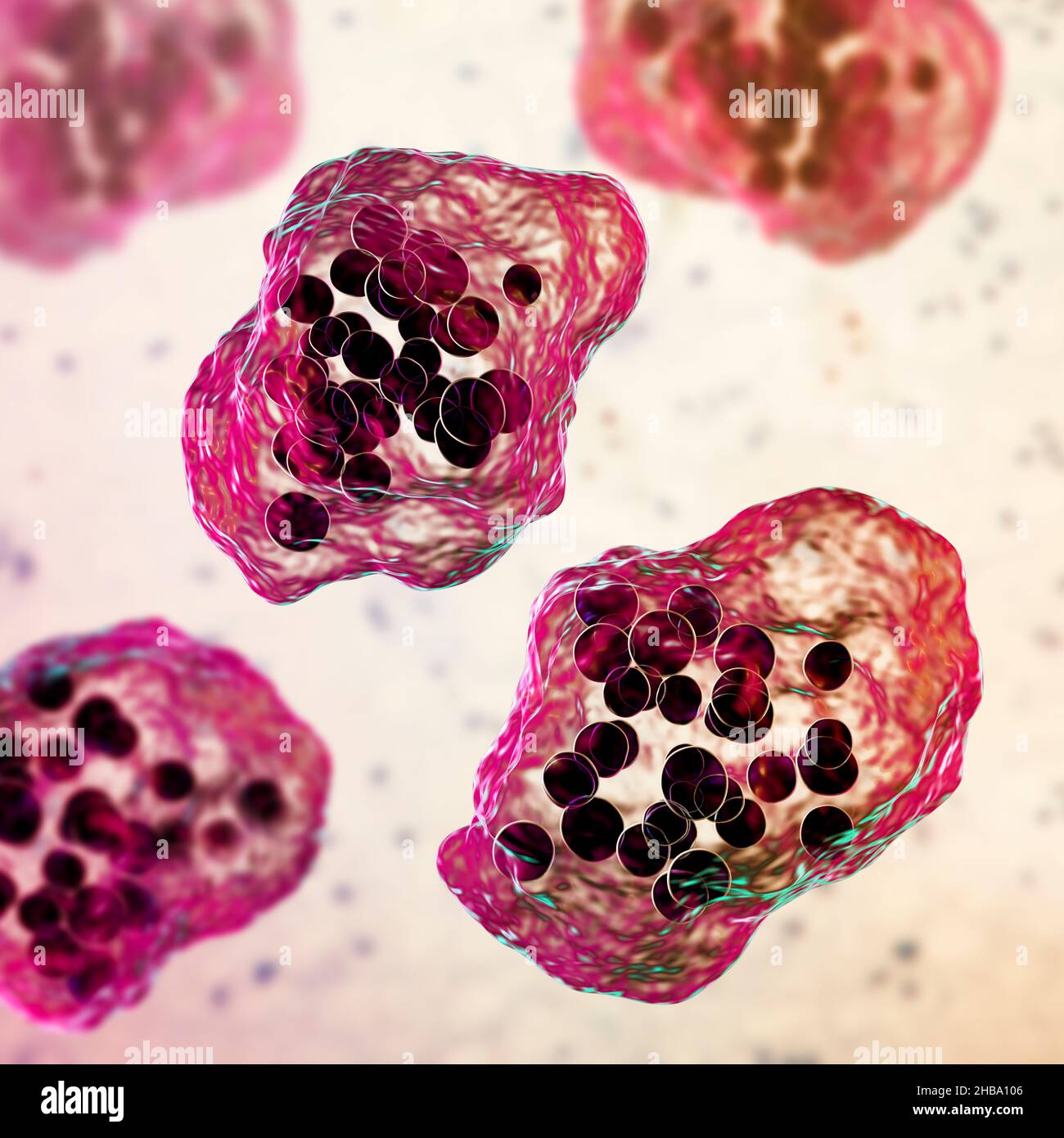 Illustration of measles virus infection showing giant multinucleated ...
