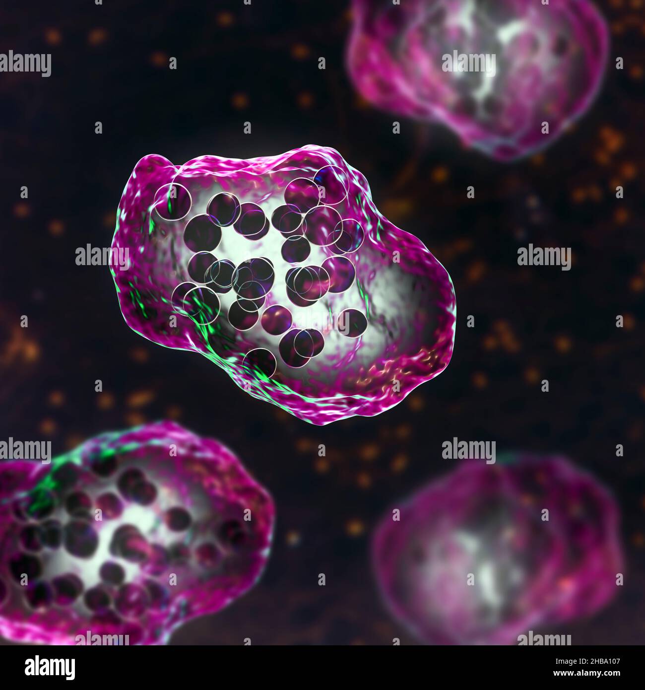 Illustration of measles virus infection showing giant multinucleated ...