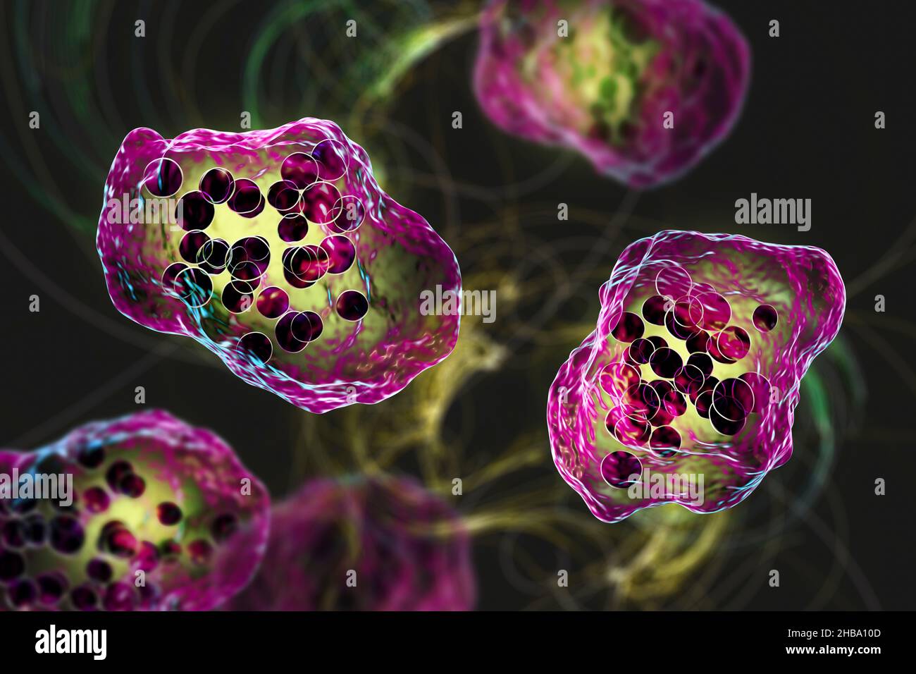 Warthin finkeldey giant cells hi-res stock photography and images - Alamy