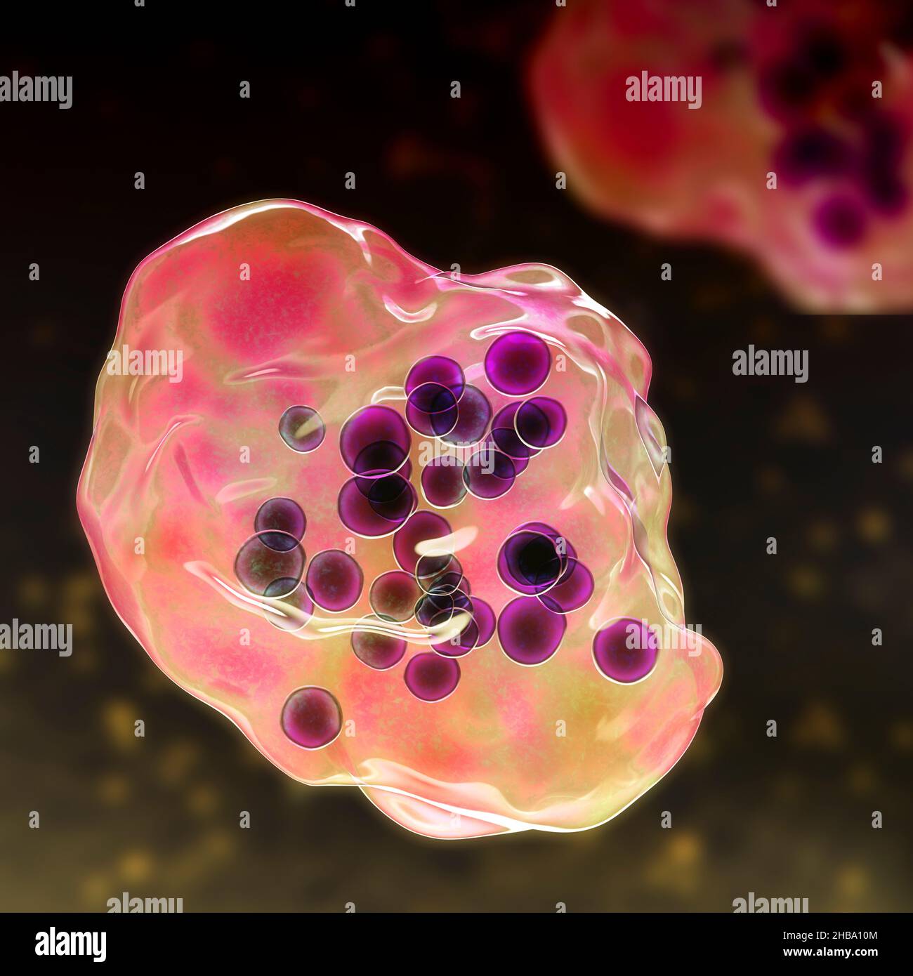 Illustration of measles virus infection showing giant multinucleated ...