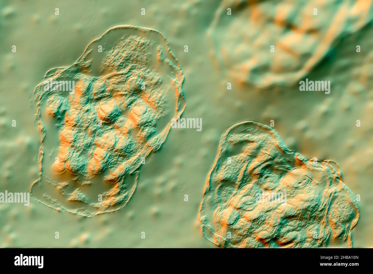 Illustration of measles virus infection showing giant multinucleated ...