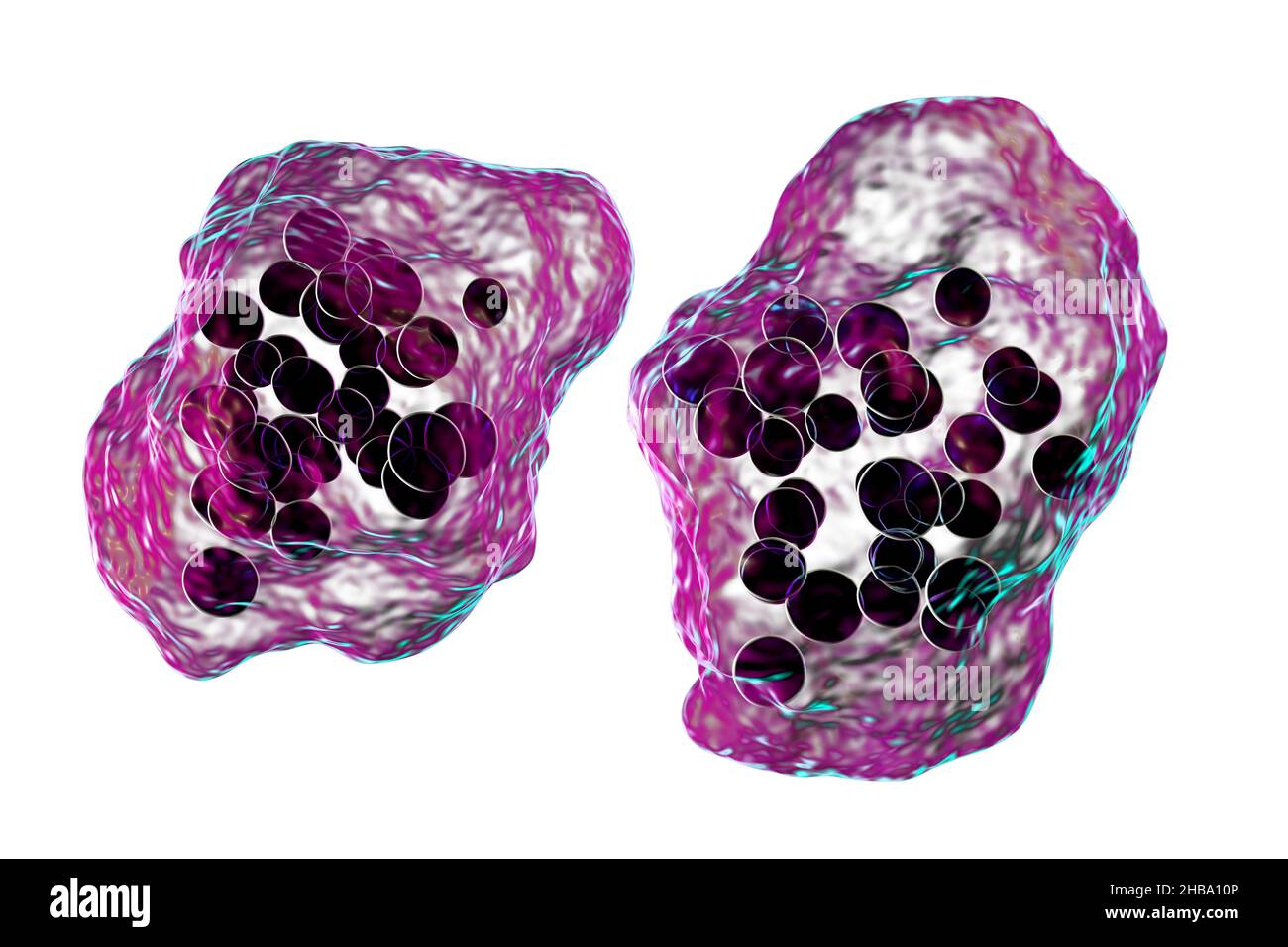Illustration of measles virus infection showing giant multinucleated ...