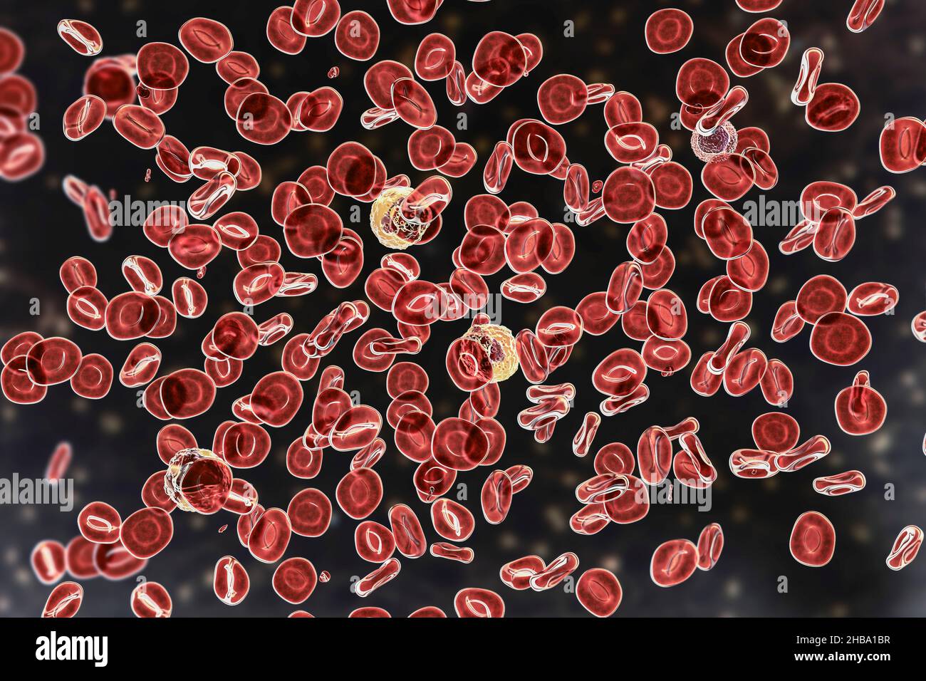 Polycythemia vera, illustration. Polycythemia vera is a rare slow ...