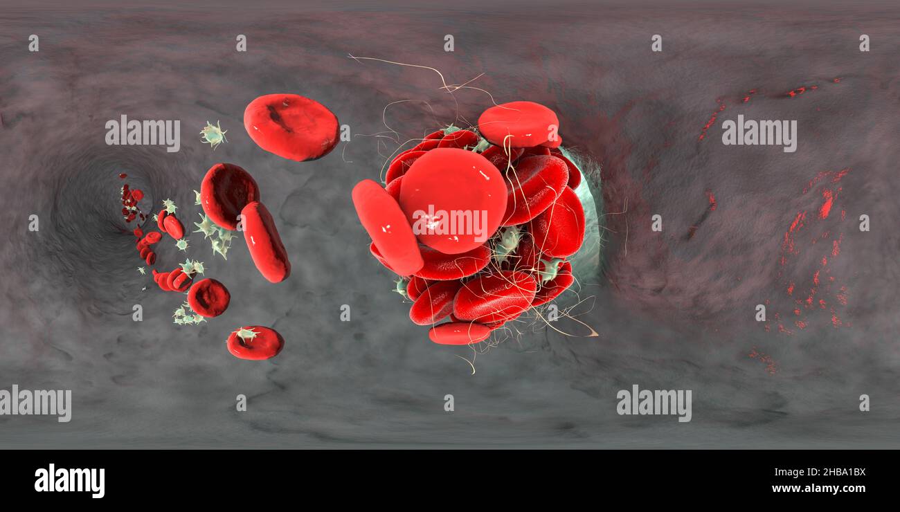 Blood clot made of red blood cells, platelets and fibrin protein ...