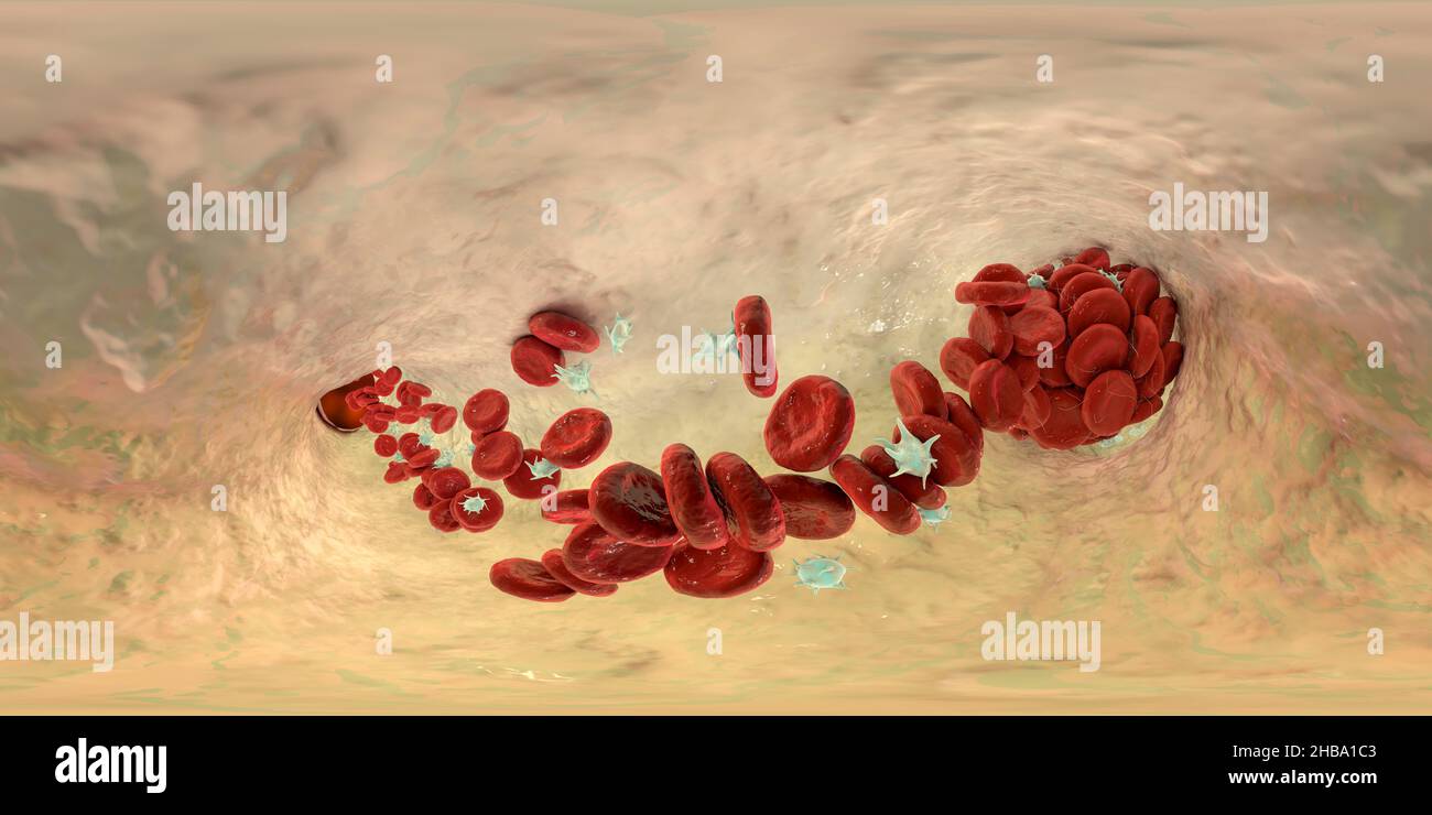 Blood clot made of red blood cells, platelets and fibrin protein ...