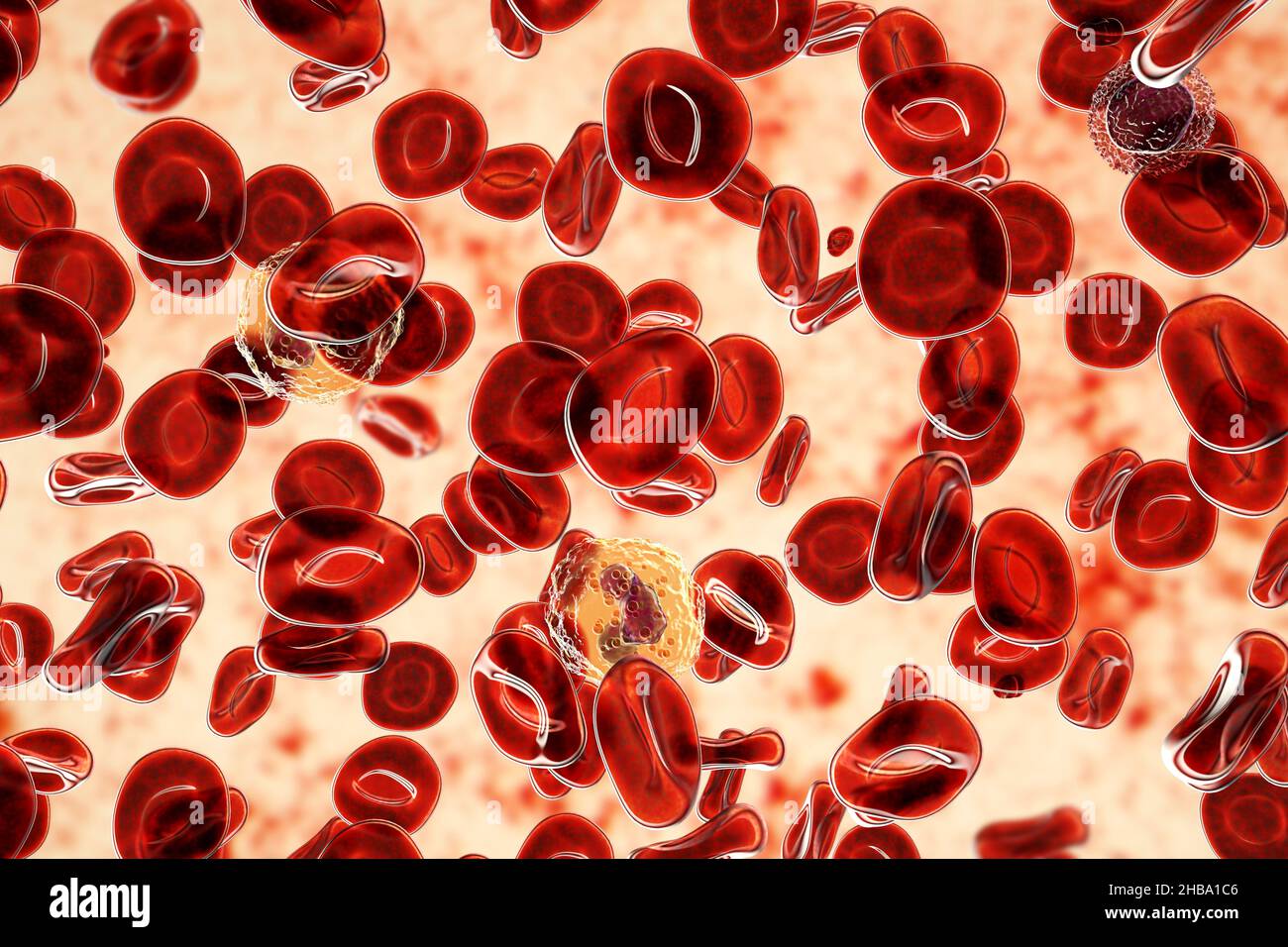 Polycythemia vera, illustration. Polycythemia vera is a rare slow ...