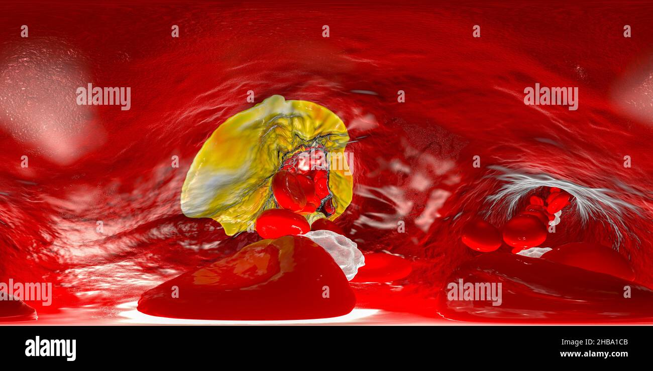 Atherosclerosis, 360 degree panorama view inside a blood vessel ...