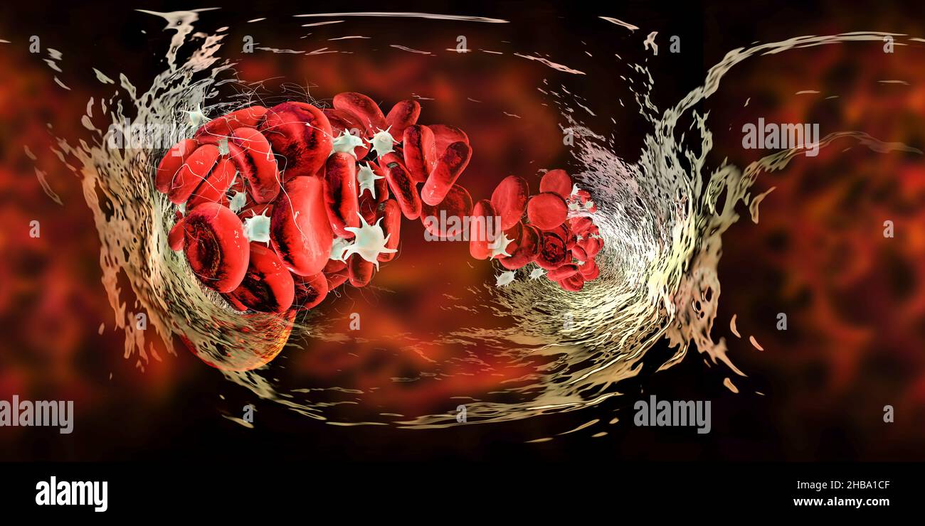 Blood clot made of red blood cells, platelets and fibrin protein ...