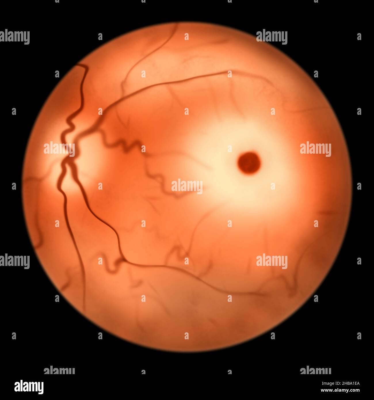 Cherry red spot tay sachs disease hi-res stock photography and images ...