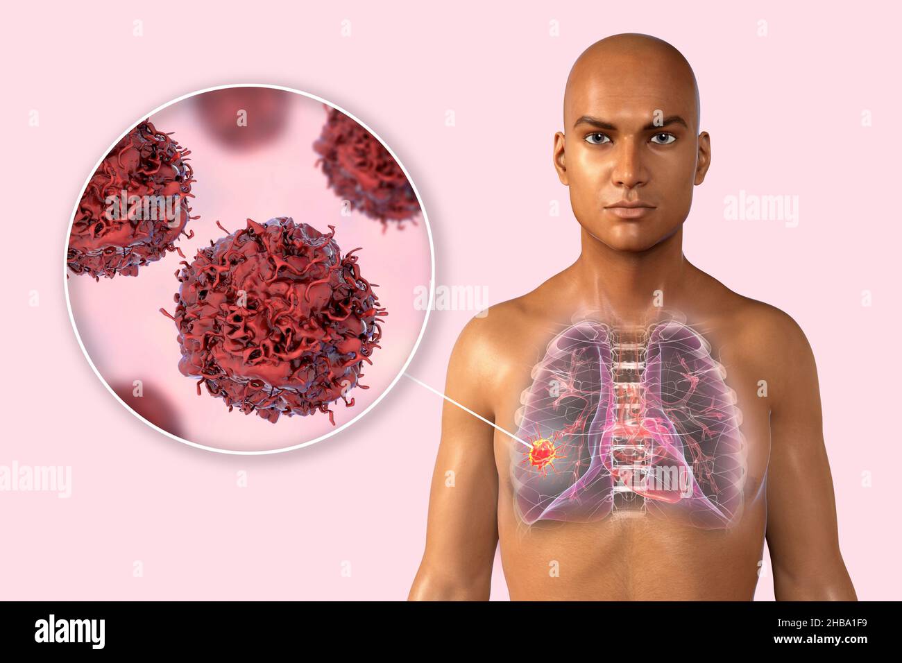 Lung Cancer Computer Illustration Showing A Tumour Inside Of A Mans Right Lung And A Close Up