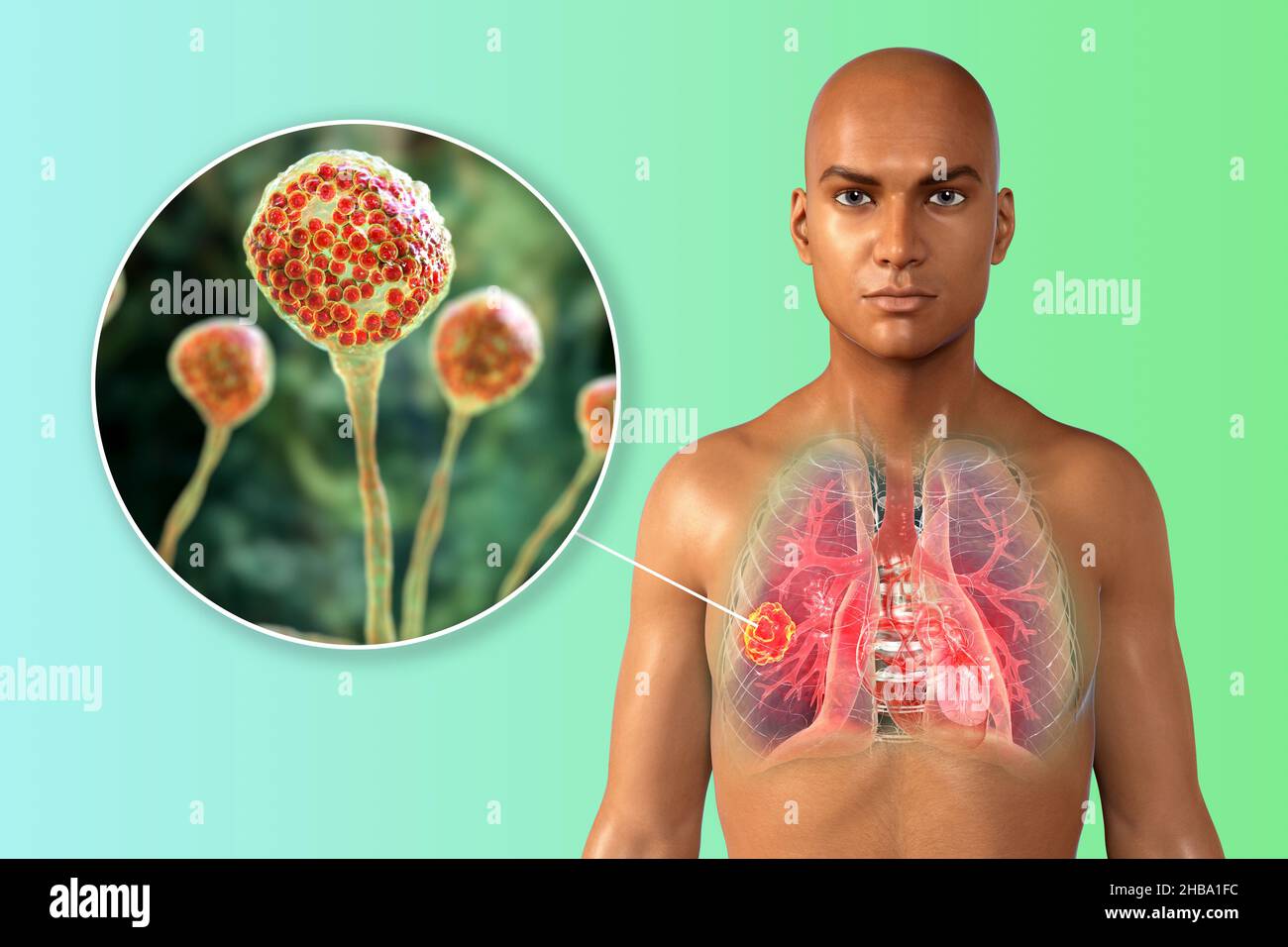 Illustration of pulmonary mucormycosis (or zygomycosis), a lung disease ...