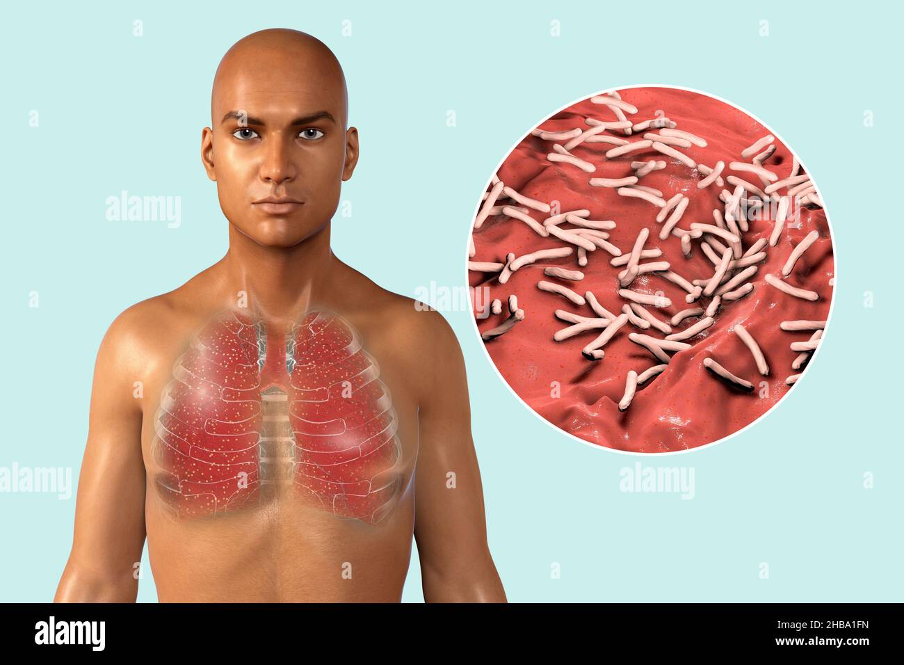 Illustration of miliary tuberculosis with a close-up view of ...