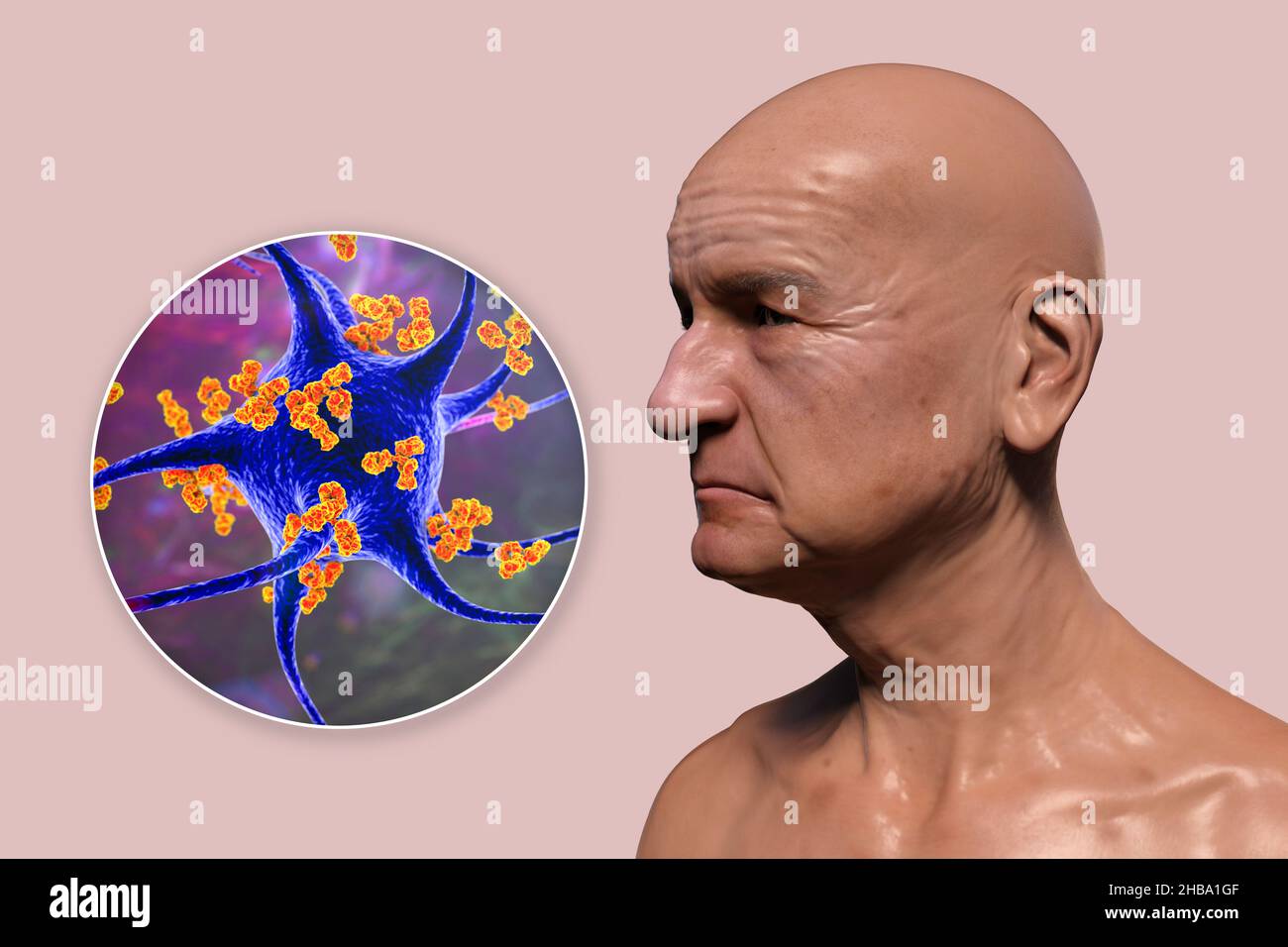 Anti-neuronal antibodies in neurodegenerative diseases and dementia ...