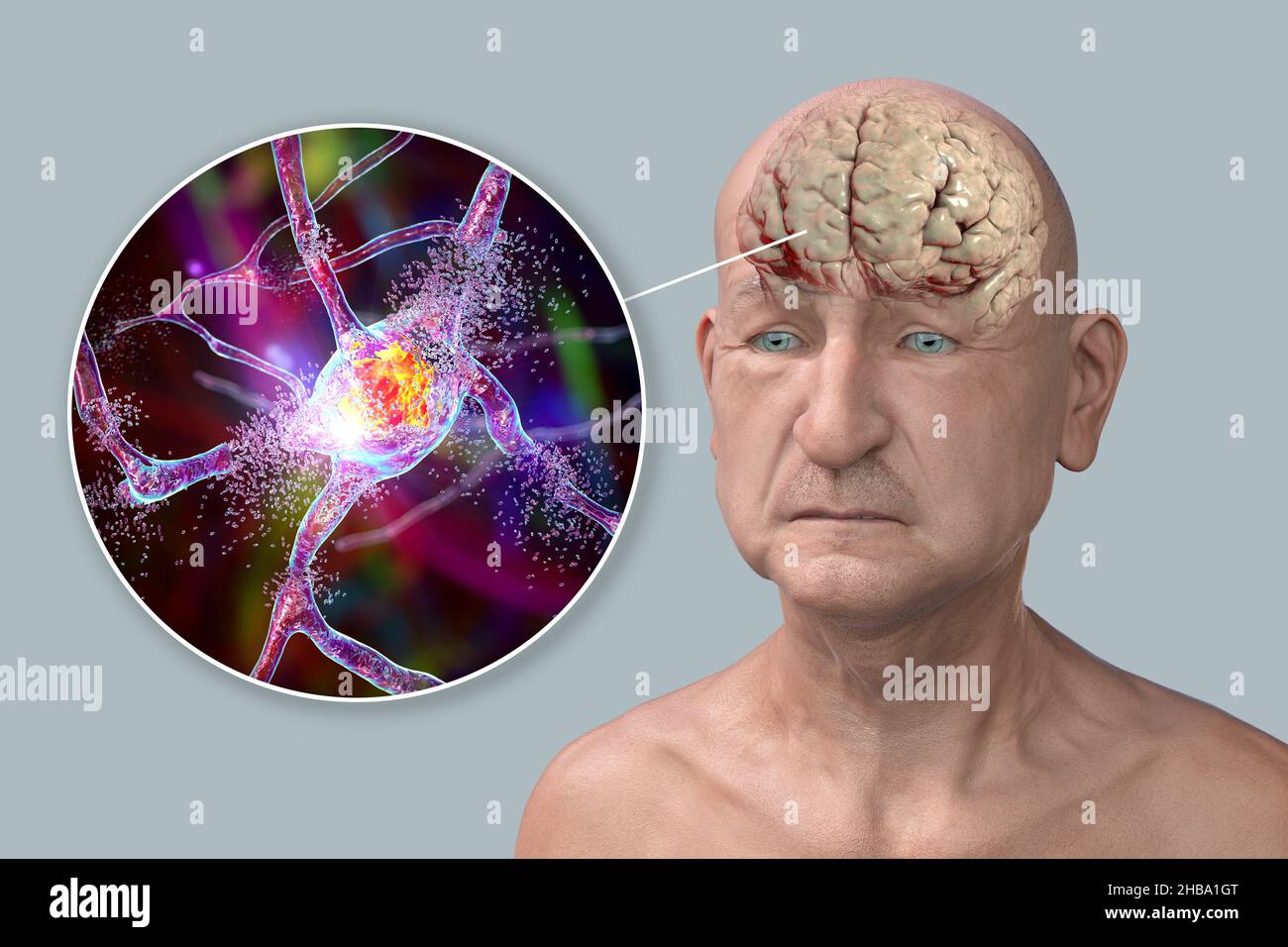 Dementia and Alzheimer's disease. Conceptual computer illustration ...