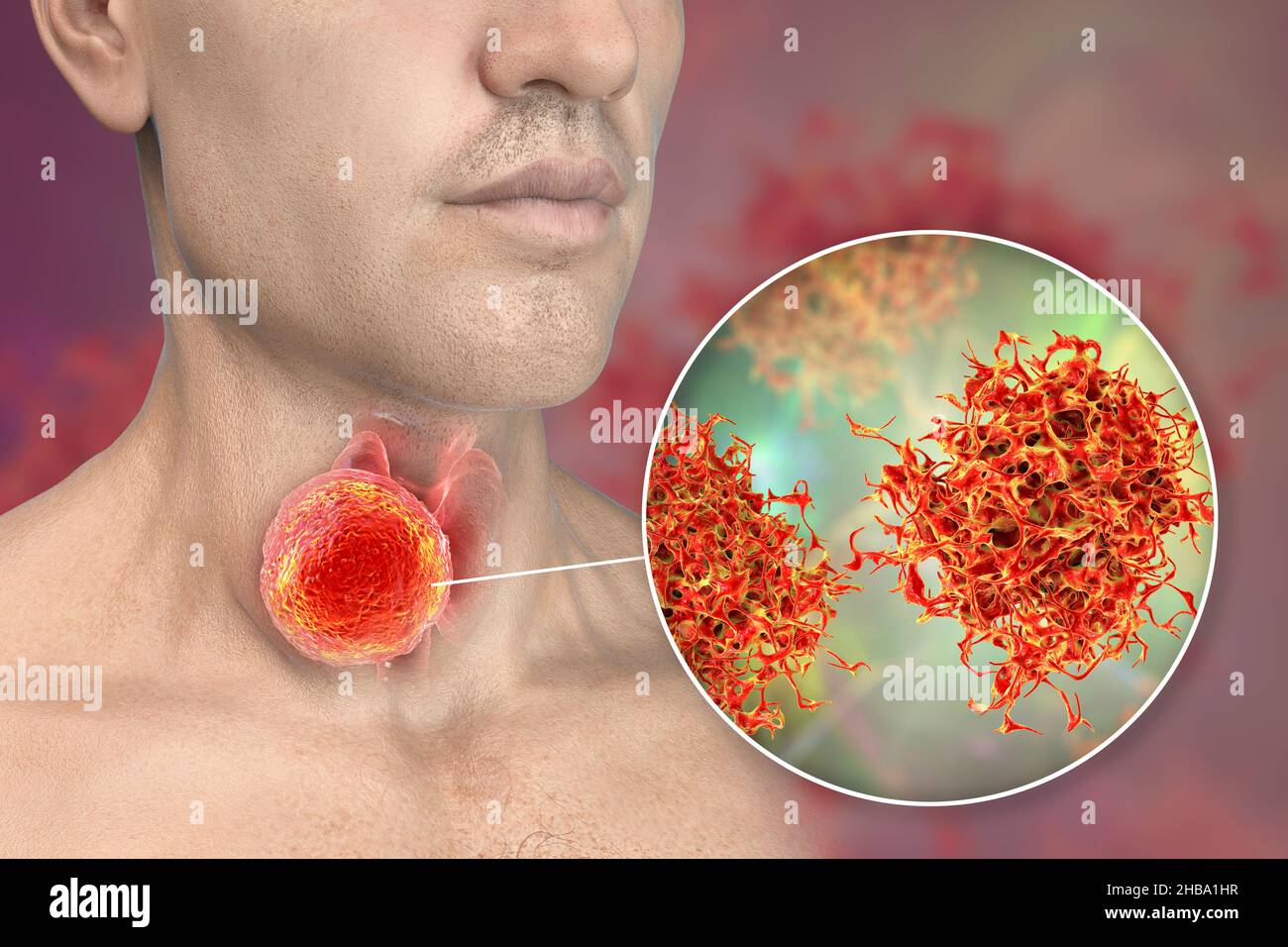 Thyroid gland cancer with a close-up view of cancer cells, computer ...