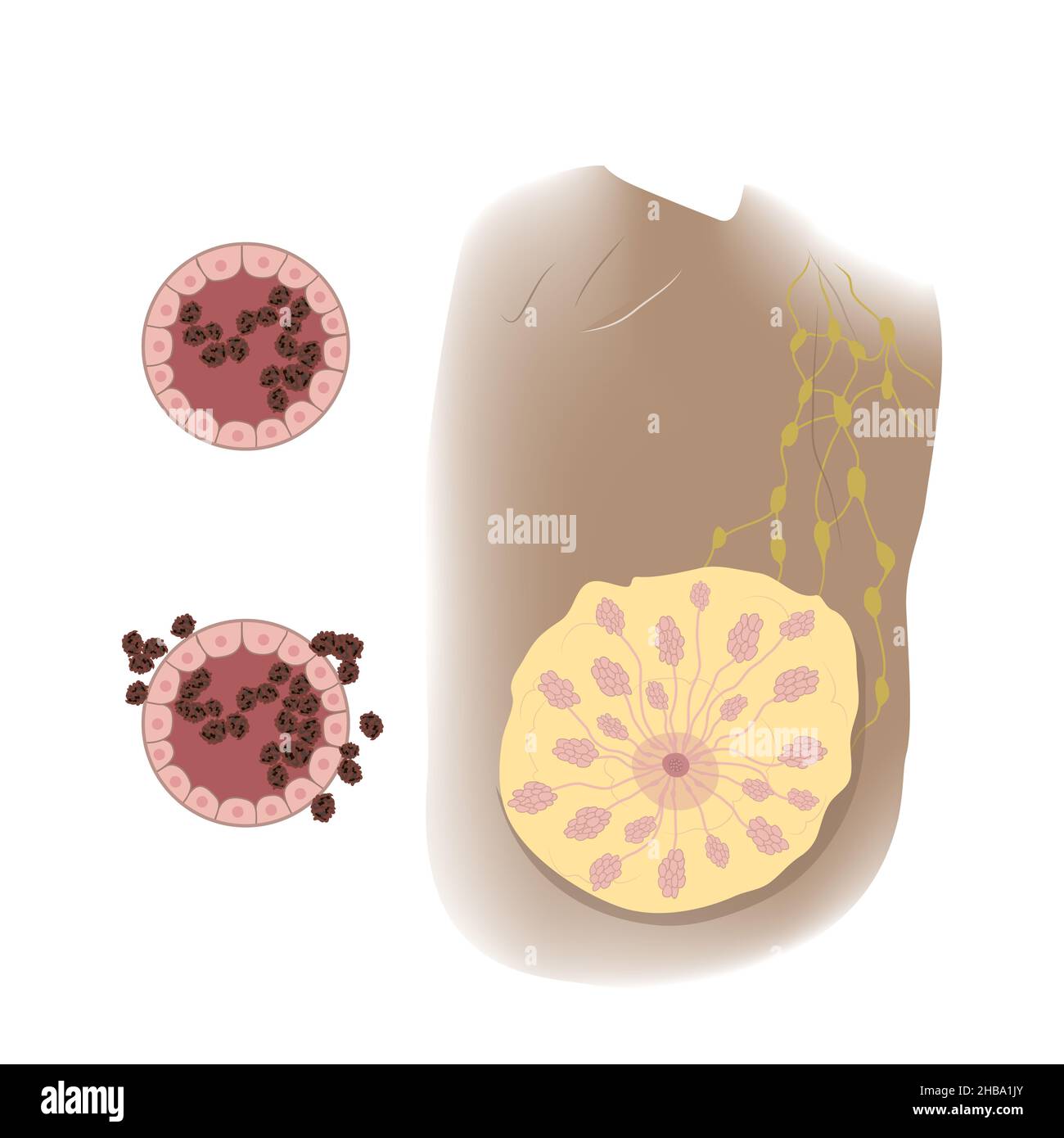Ductal cancer in female breast, illustration. In situ and invasive ...