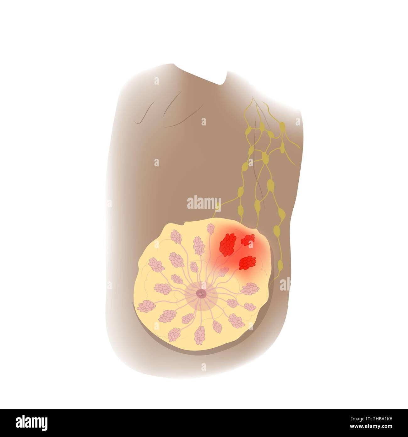 Mastitis in female breast, illustration Stock Photo - Alamy