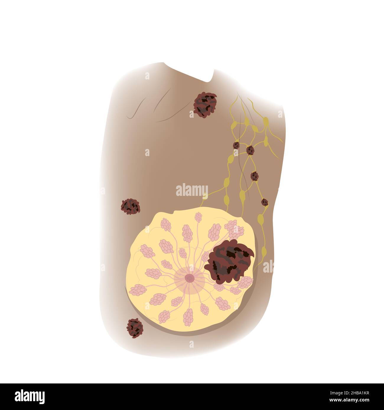 Female breast cancer T4, illustration. At this stage the tumour extends ...
