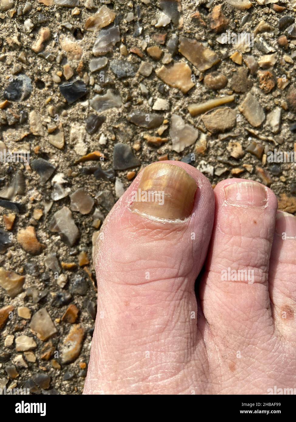 Toenail care for nail fungus - thickened big toe nail of a person ...