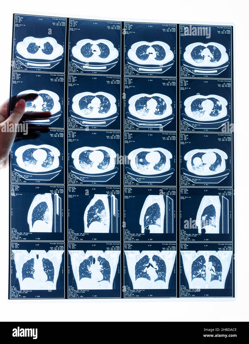 Girl holding X-ray diagnosis of sick man covid 19 Stock Photo - Alamy