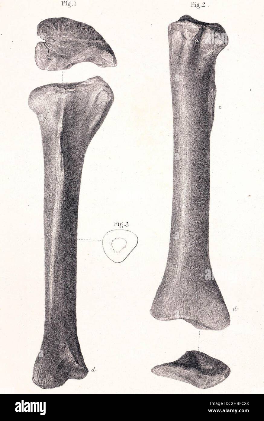Referred tibia, lateral view (left), posterior view (right). Lithograph ...