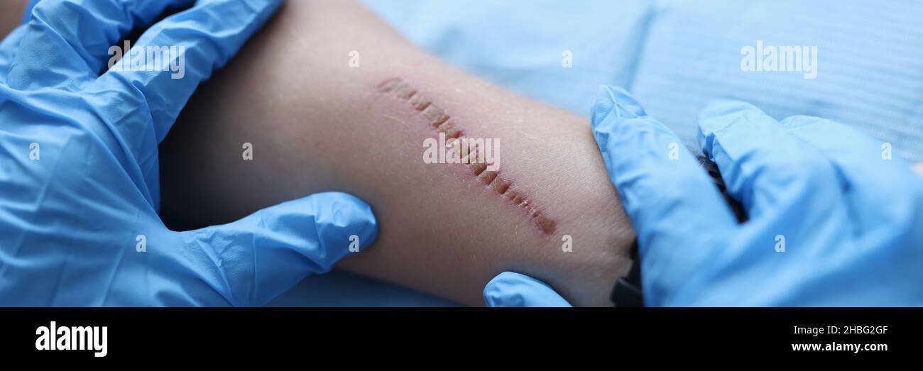 Scar hand hi-res stock photography and images - Alamy