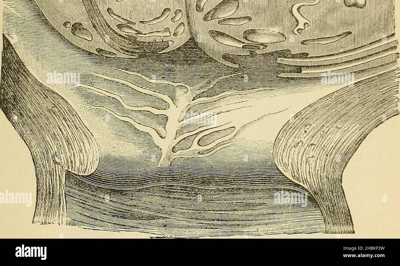 Uterine fibroid hi-res stock photography and images - Alamy