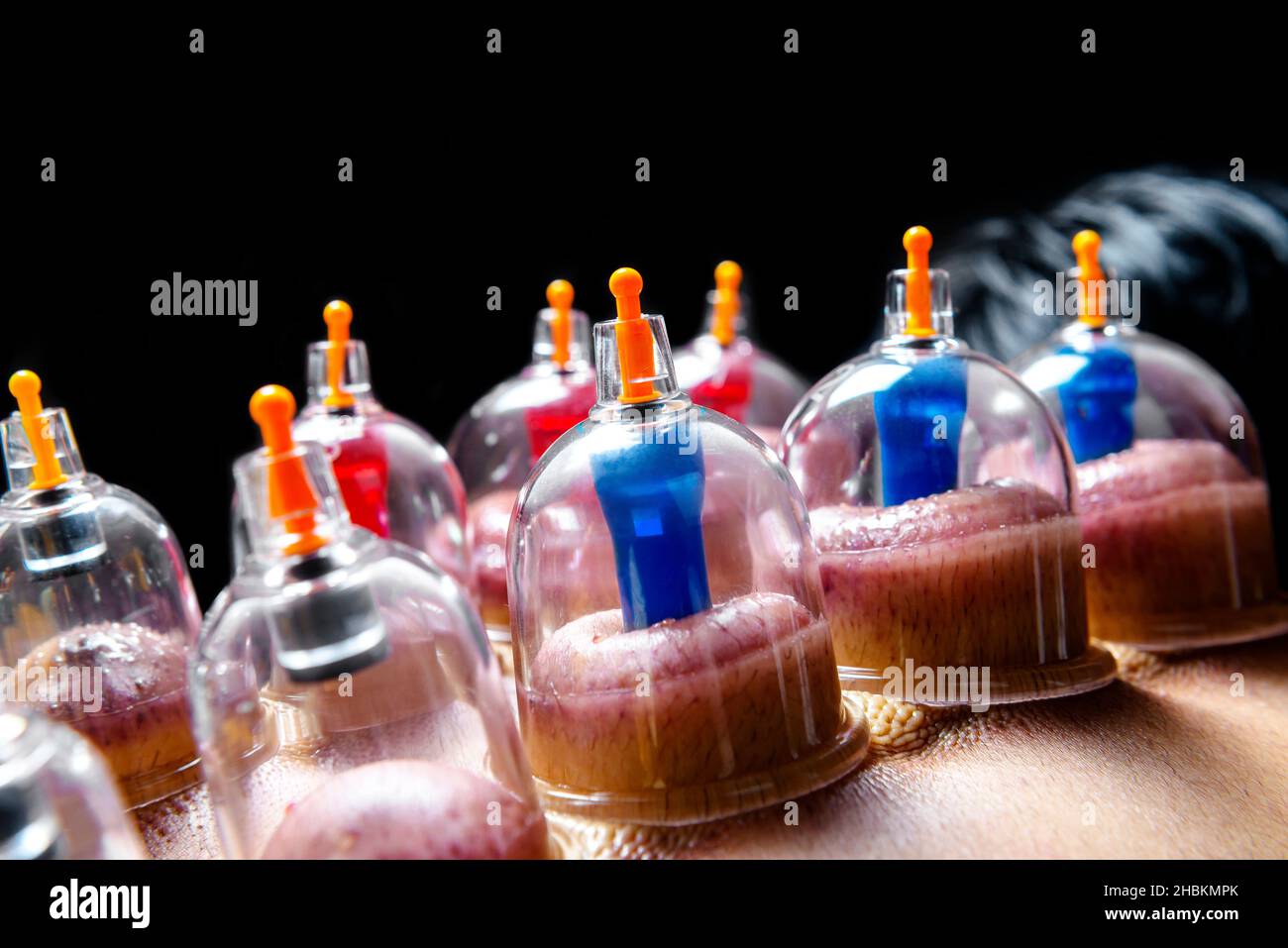 Man with cupping treatment on the back with black background Stock ...