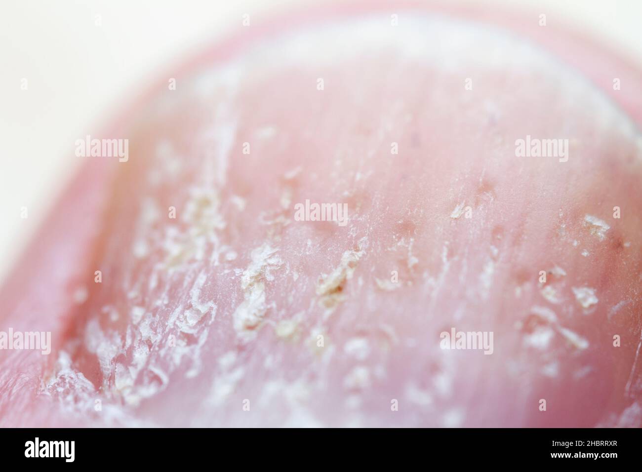 Extreme close up of psoriasis at the nail. Psoriasis is an autoimmune ...