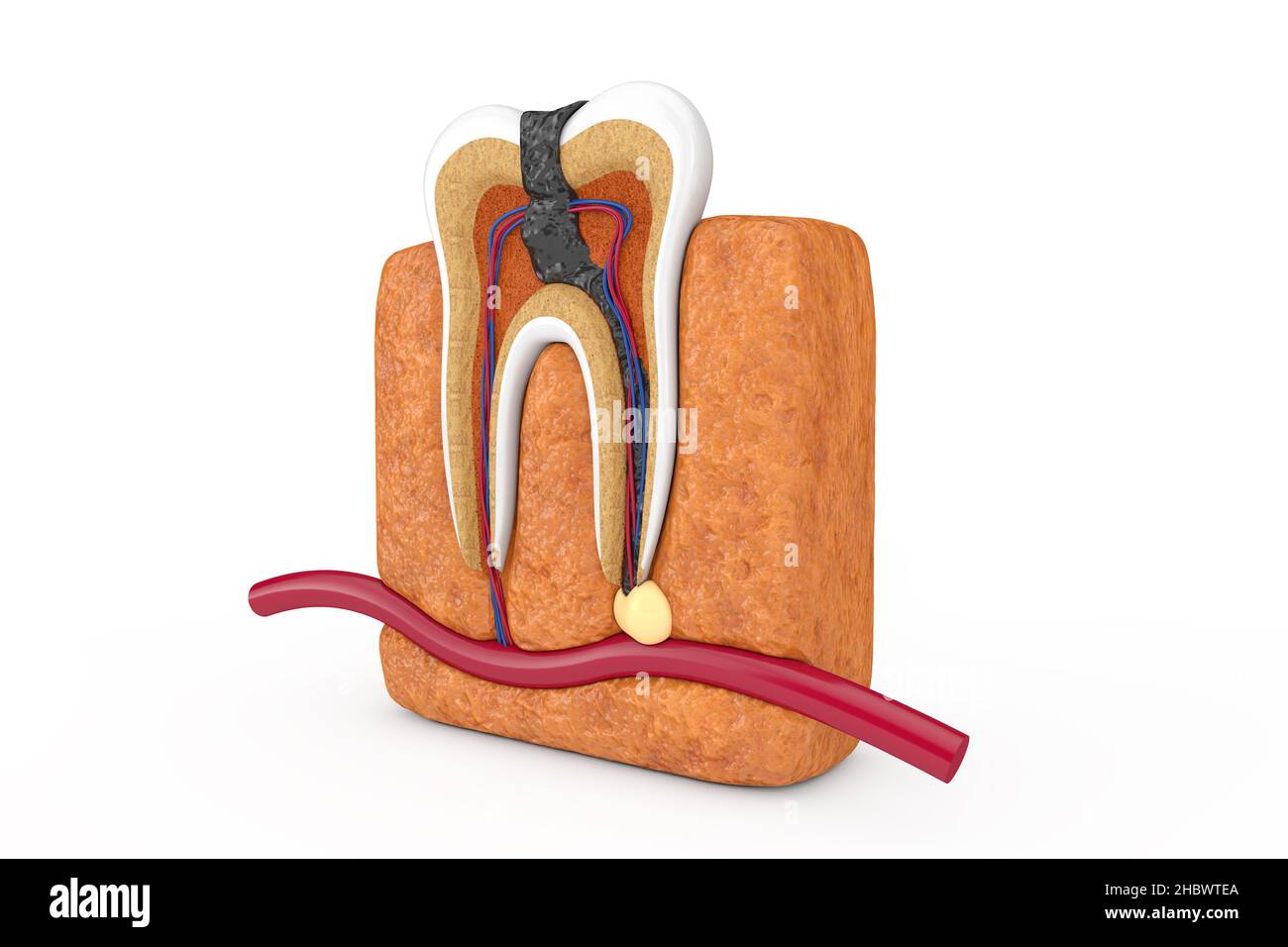 Inside of Decay Tooth on a white background. 3d Rendering Stock Photo ...