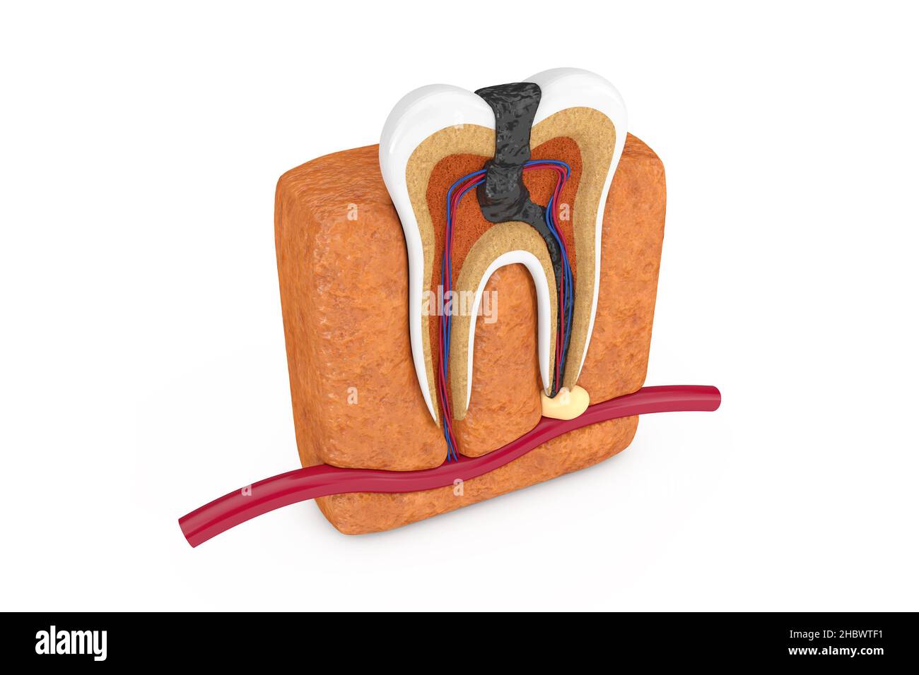 Inside of Decay Tooth on a white background. 3d Rendering Stock Photo ...