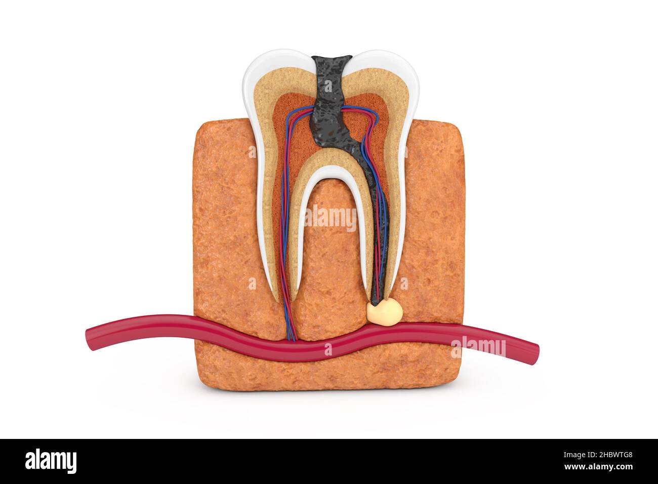 Inside of Decay Tooth on a white background. 3d Rendering Stock Photo ...