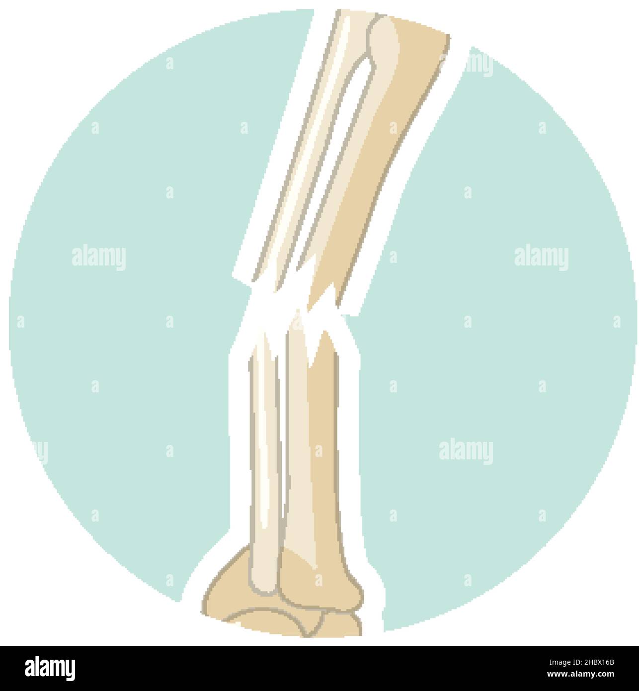 Human broken bone in cartoon style illustration Stock Vector Image ...