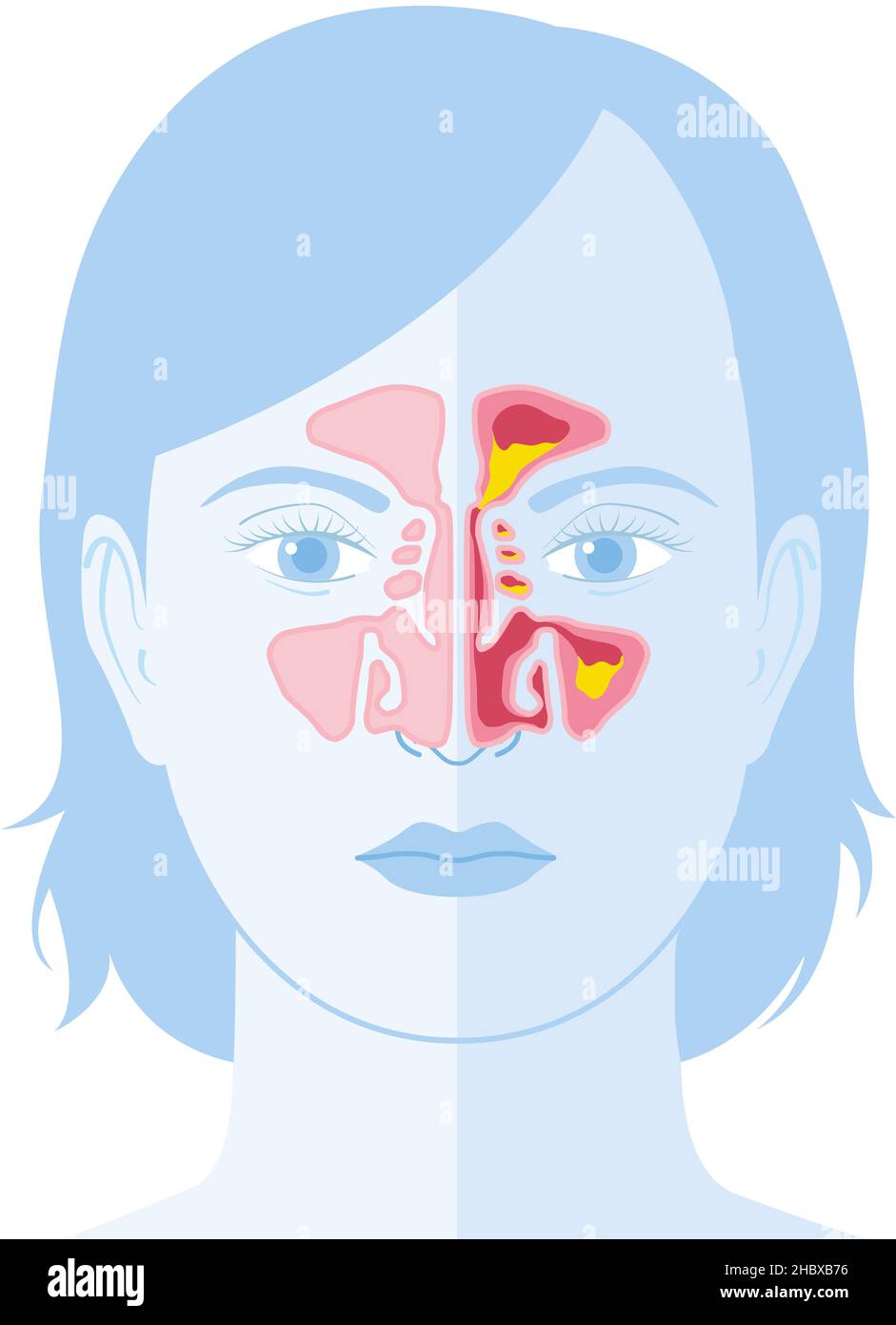 Vector illustration showing healthy sinus and sinusitis with inflamed ...