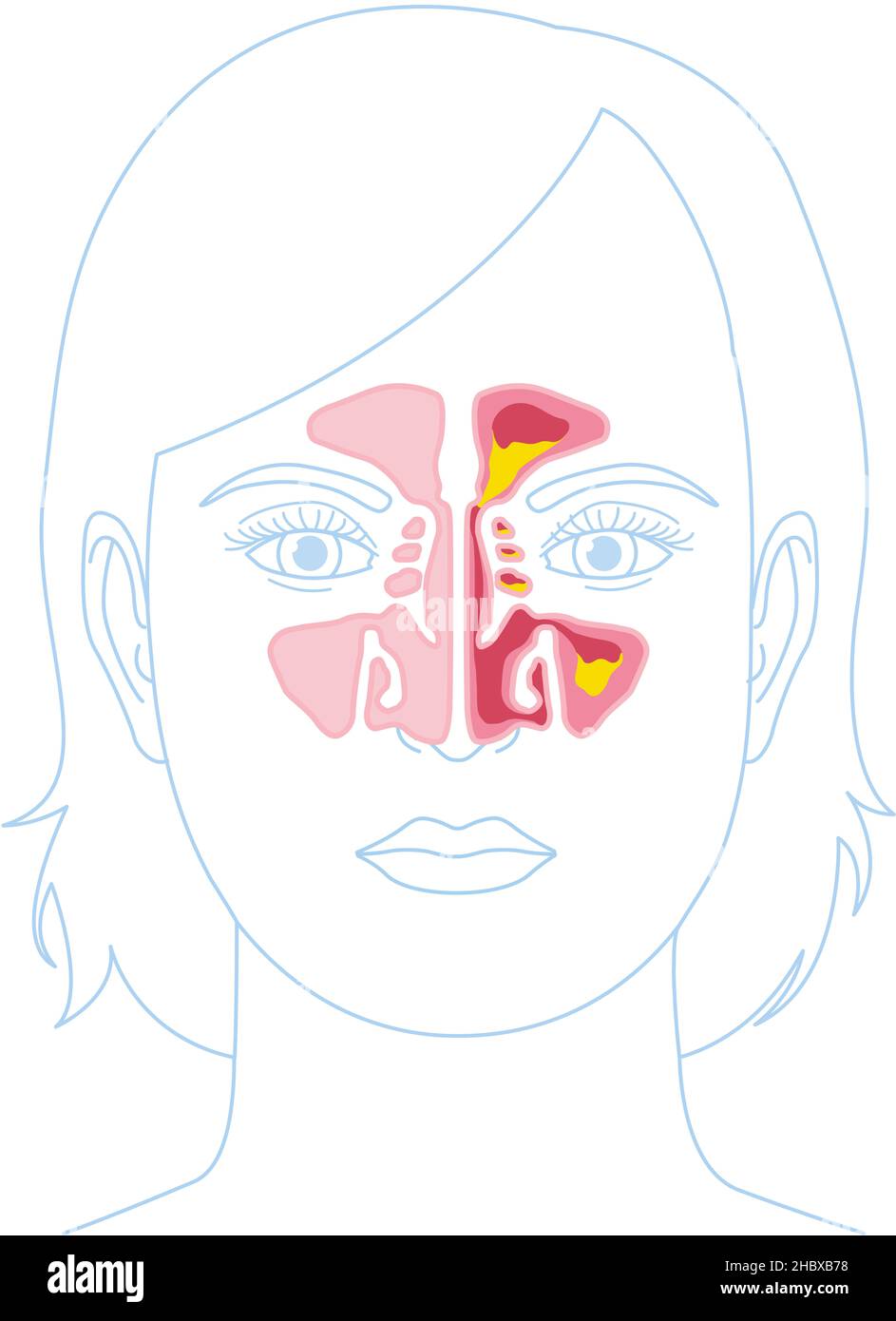 Vector illustration showing healthy sinus and sinusitis with inflamed ...