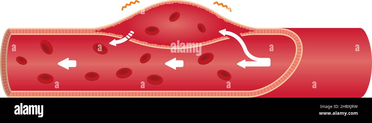 Vector illustration of aortic dissection (no text Stock Vector Image ...