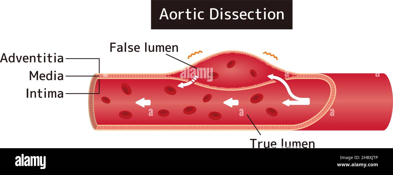 Aortic Dissection Cross Section