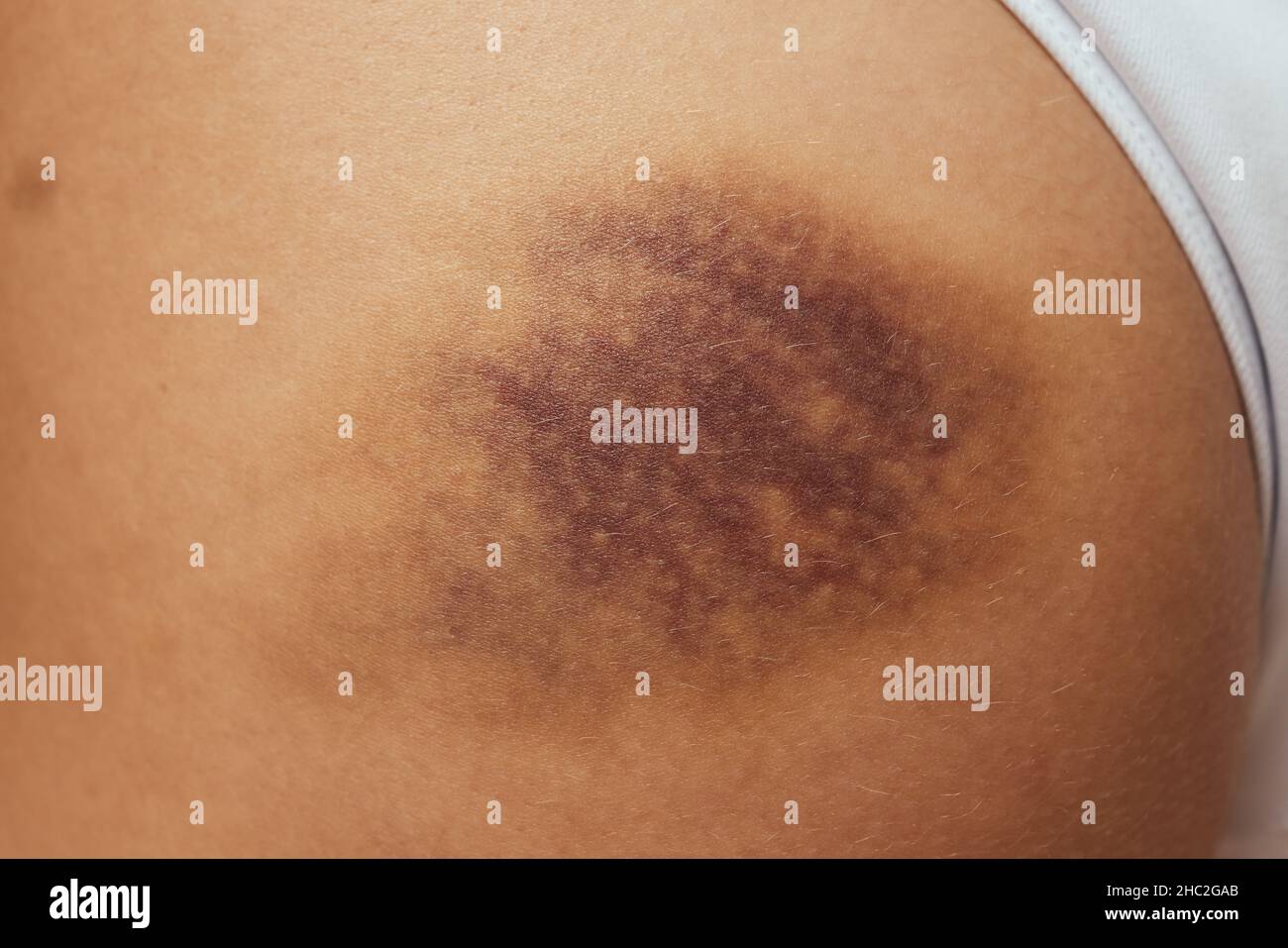 Hematoma and Large Bruise, blood under skin Congestion Stock Photo - Alamy