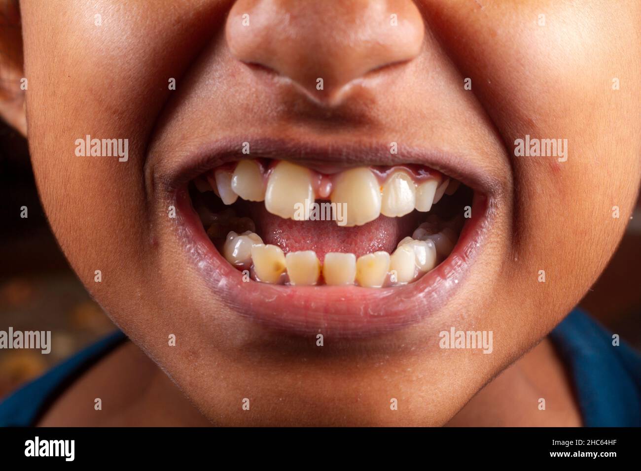 Crowding teeth hi-res stock photography and images - Alamy