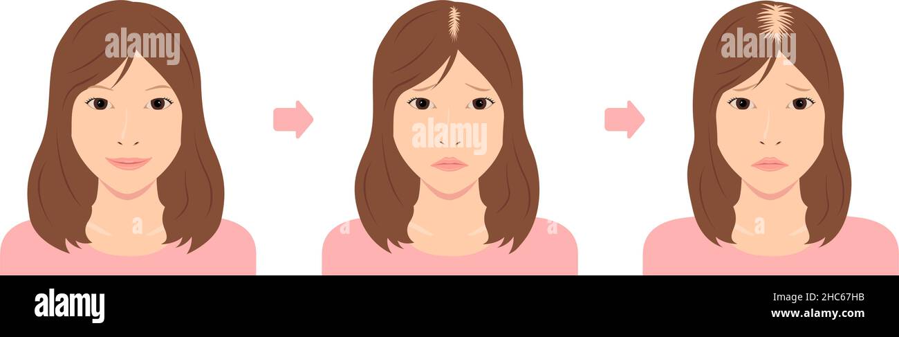 Progress Of Female Androgenetic Alopecia Vector Illustration Stock