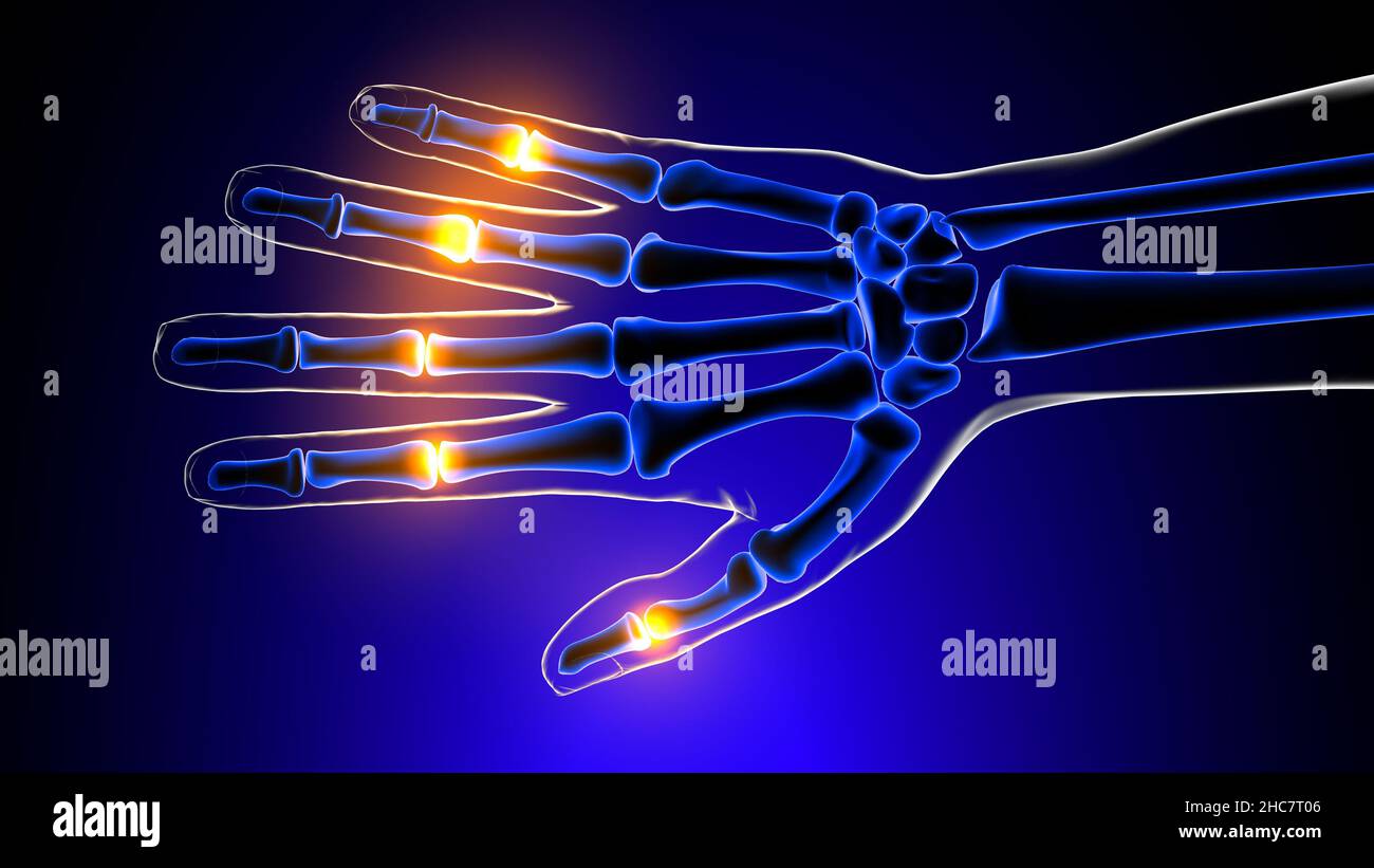 Proximal interphalangeal joints pain Anatomy For Medical Concept 3D ...