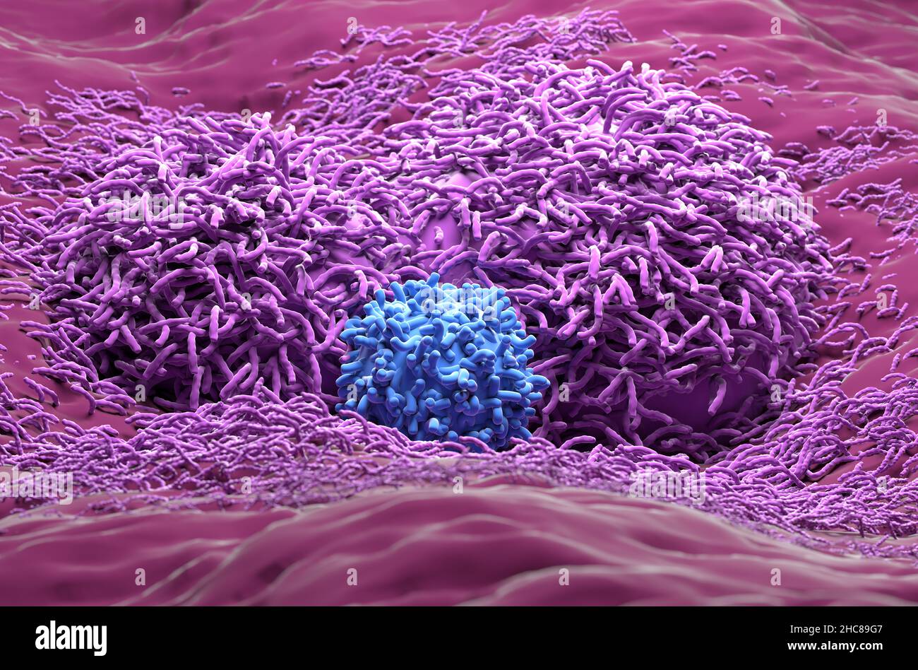 Liver cancer hepatoma realistic side closeup view 3d illustration Stock ...