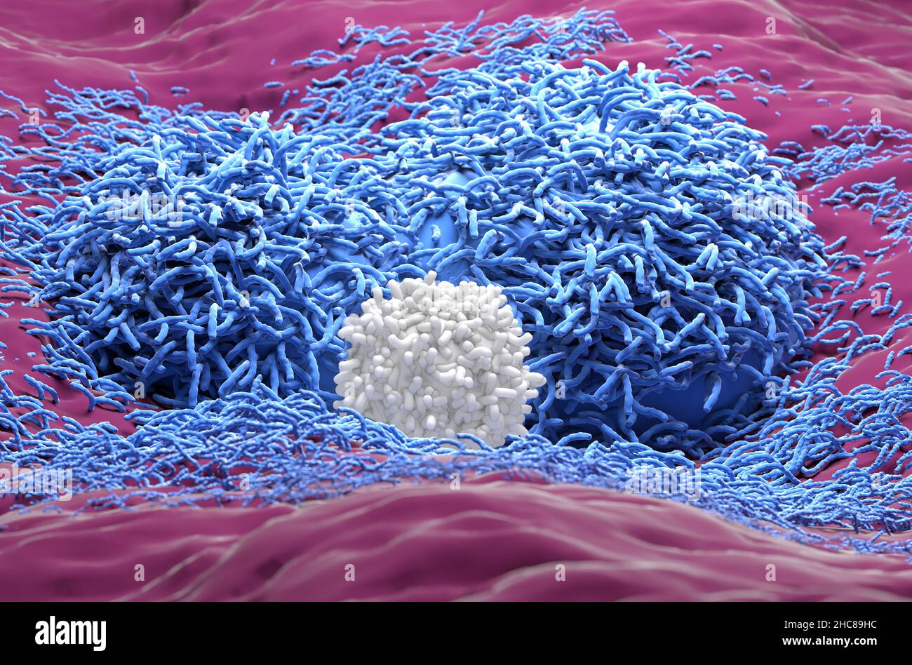 Carcinoid tumor hi-res stock photography and images - Alamy