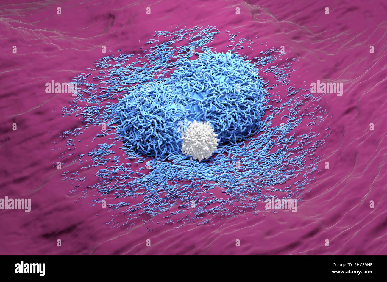Liver cancer hepatoma blue color with t-cell realistic isometric view ...
