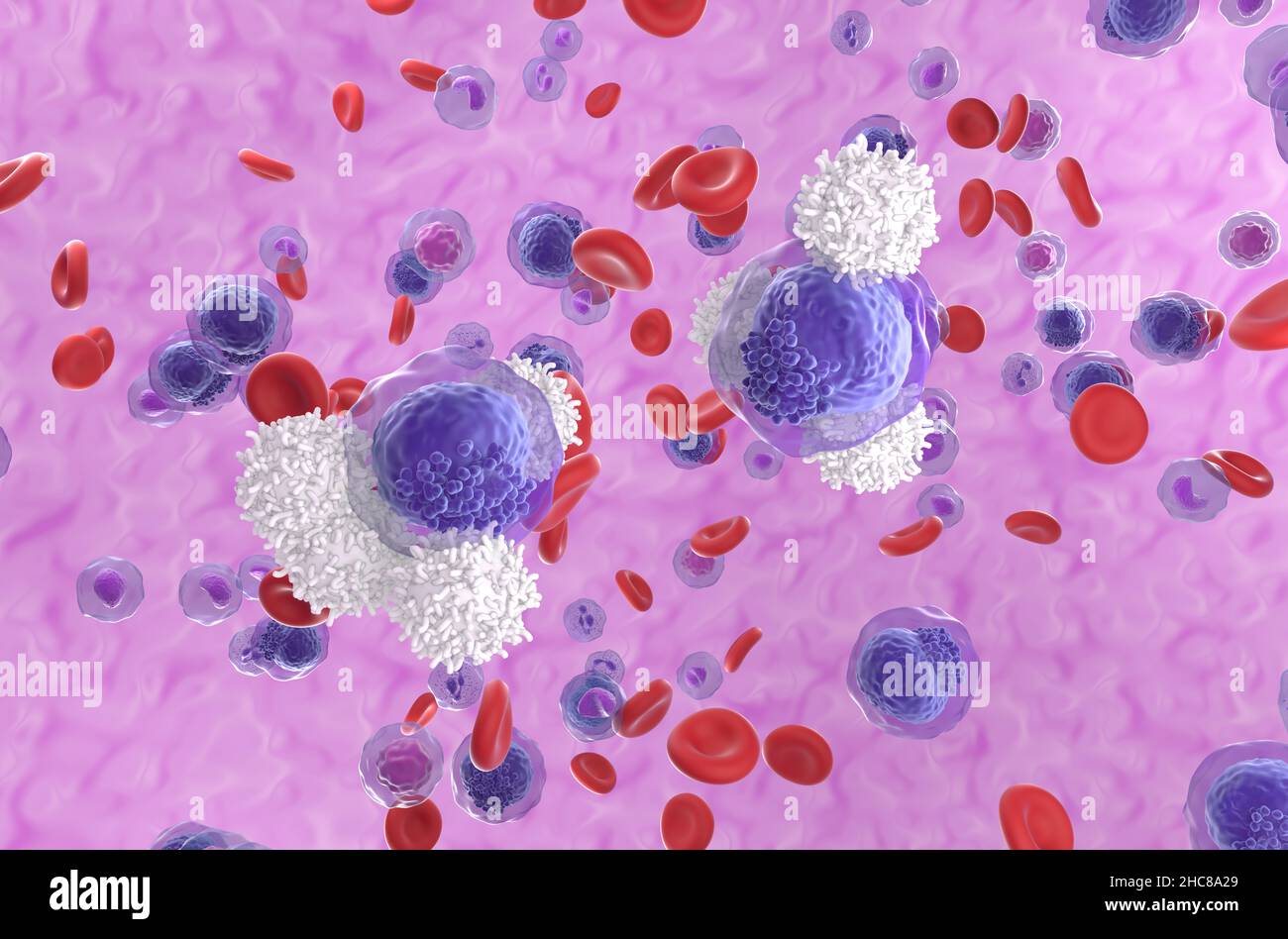 T-cells attack acute myeloid leukemia (AML) cells in blood flow ...